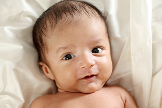 Strabismus (mata juling): Penyebab dan pengobatan