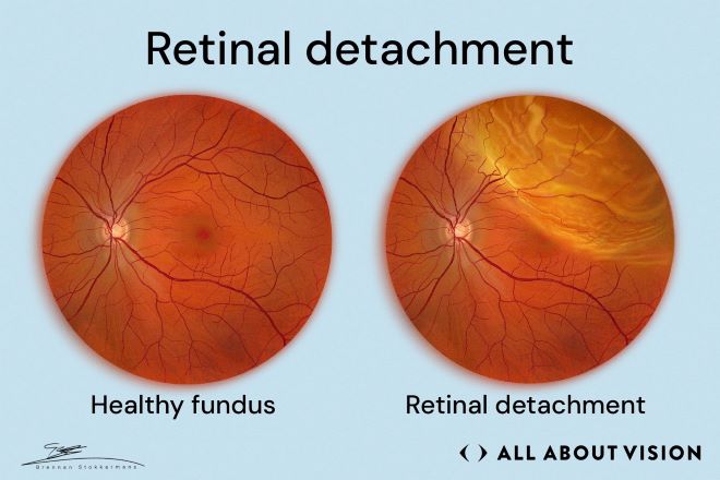 Rhegmatogenous retinal detachment