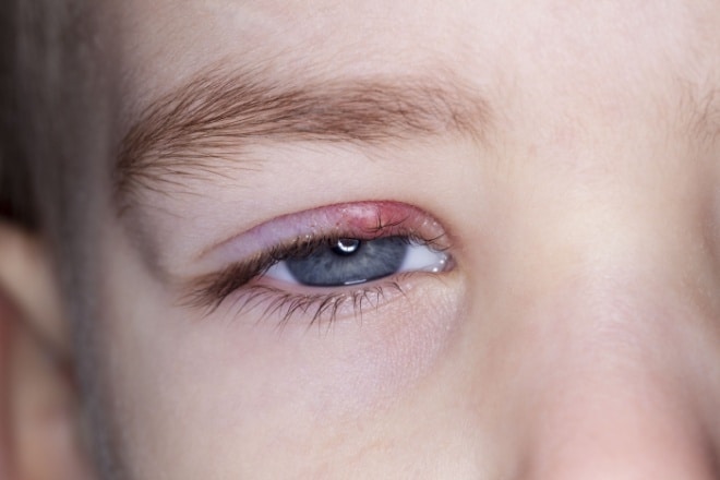 Stye (Sty or Hordeolum): Causes, Symptoms and Home Remedies