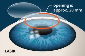 During LASIK