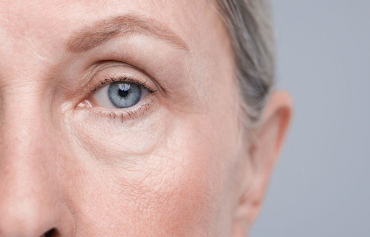 What Is Eye Bag Surgery (Lower Blepharoplasty)?